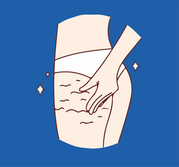 The Ultimate Guide to Understanding and Treating Cellulite: Causes, Ri ...